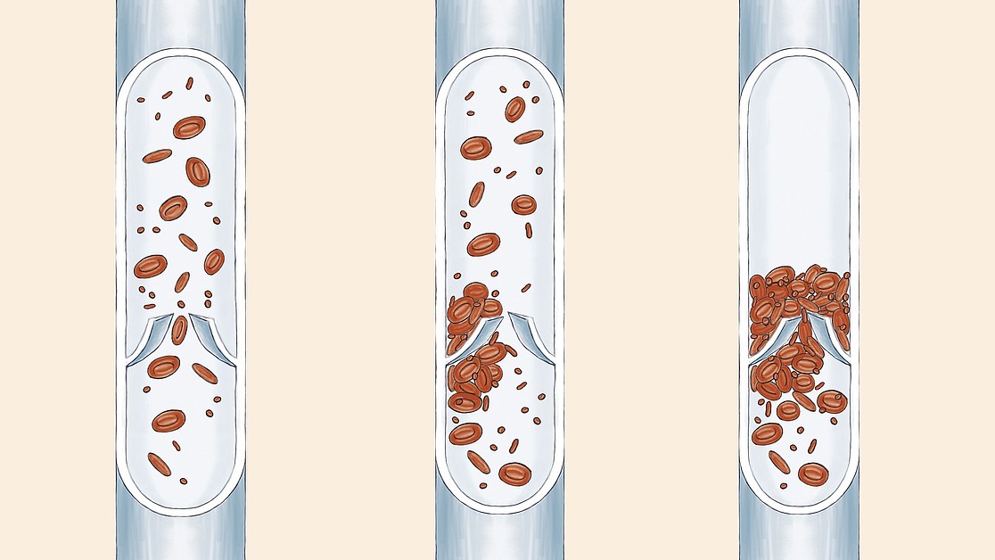 Recognise leg vein thrombosis: Symptoms and therapy | medi